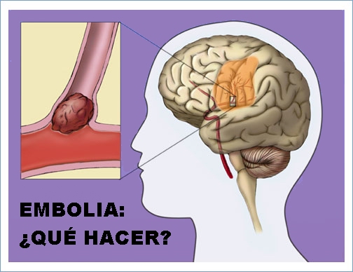 Como Detectar Y Detener Una Embolia